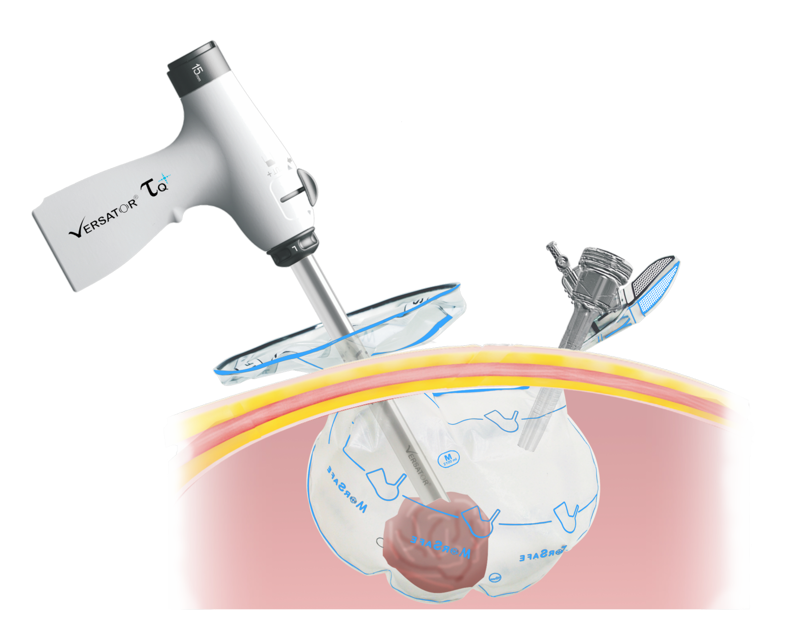 Morcellatie zak - Morsafe - Medical Dynamics
