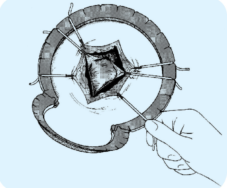 Lonestar retractors - Medical Dynamics