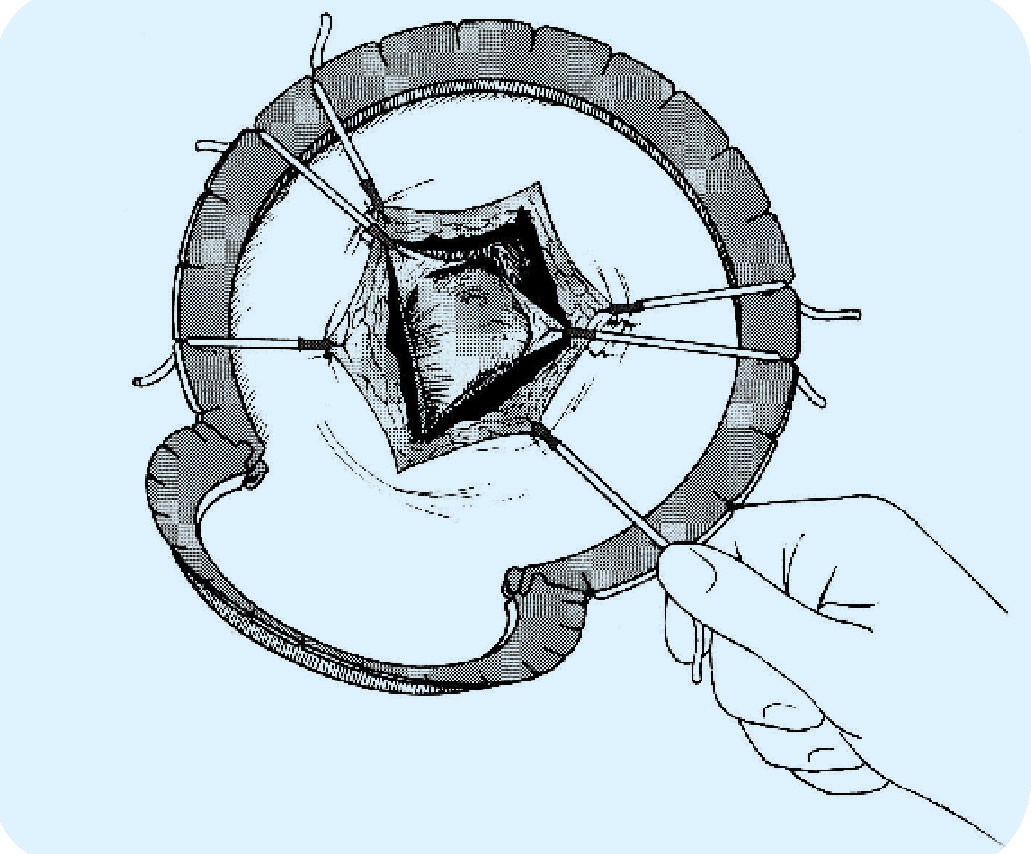 Lonestar retractors - Medical Dynamics