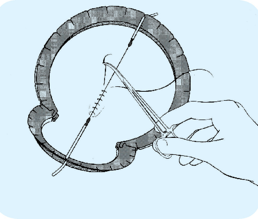 Lonestar retractors - Medical Dynamics